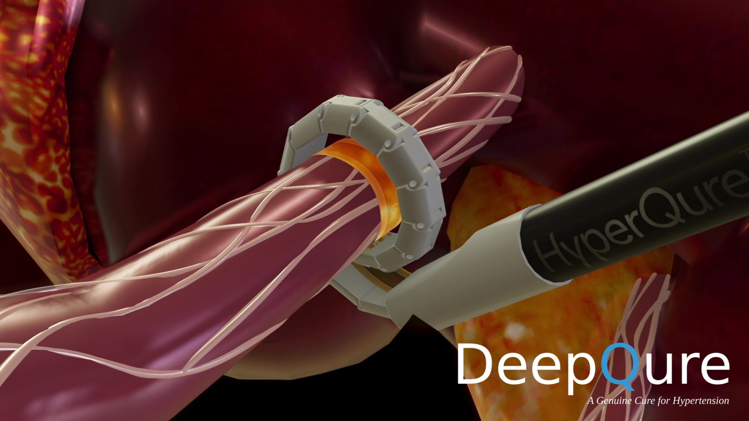 DeepQure advances clinical trials of its HyperQure extravascular renal denervation system ...