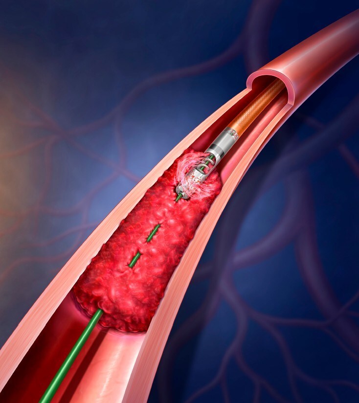 BD to initiate real-world patient registry for Rotarex atherectomy ...