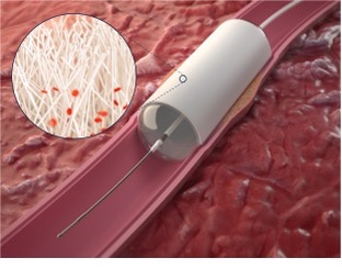 StentIt launches first-in-human trial of bioresorbable stent to treat ...