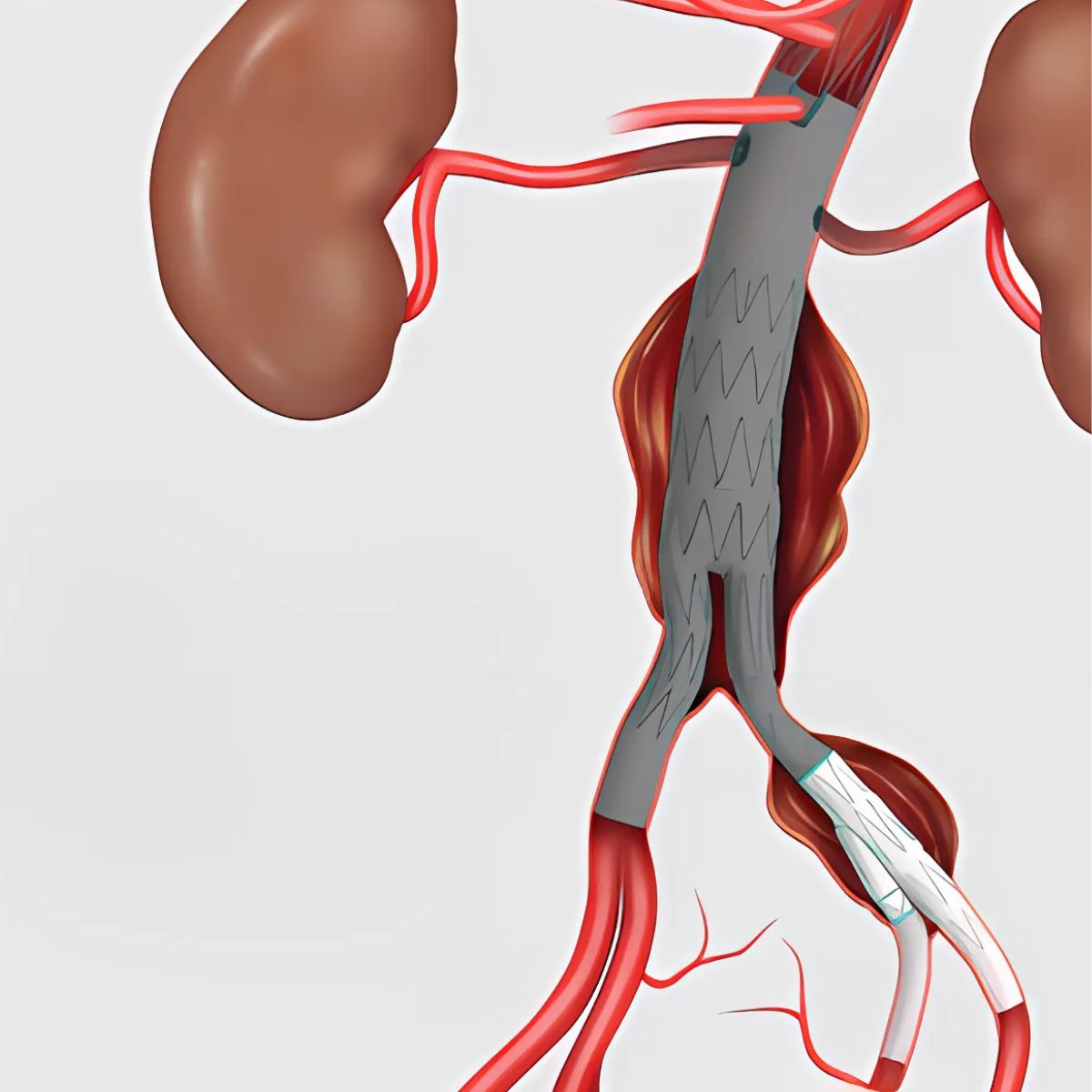 Cook Medical announces US launch of Zenith iliac branch device ...