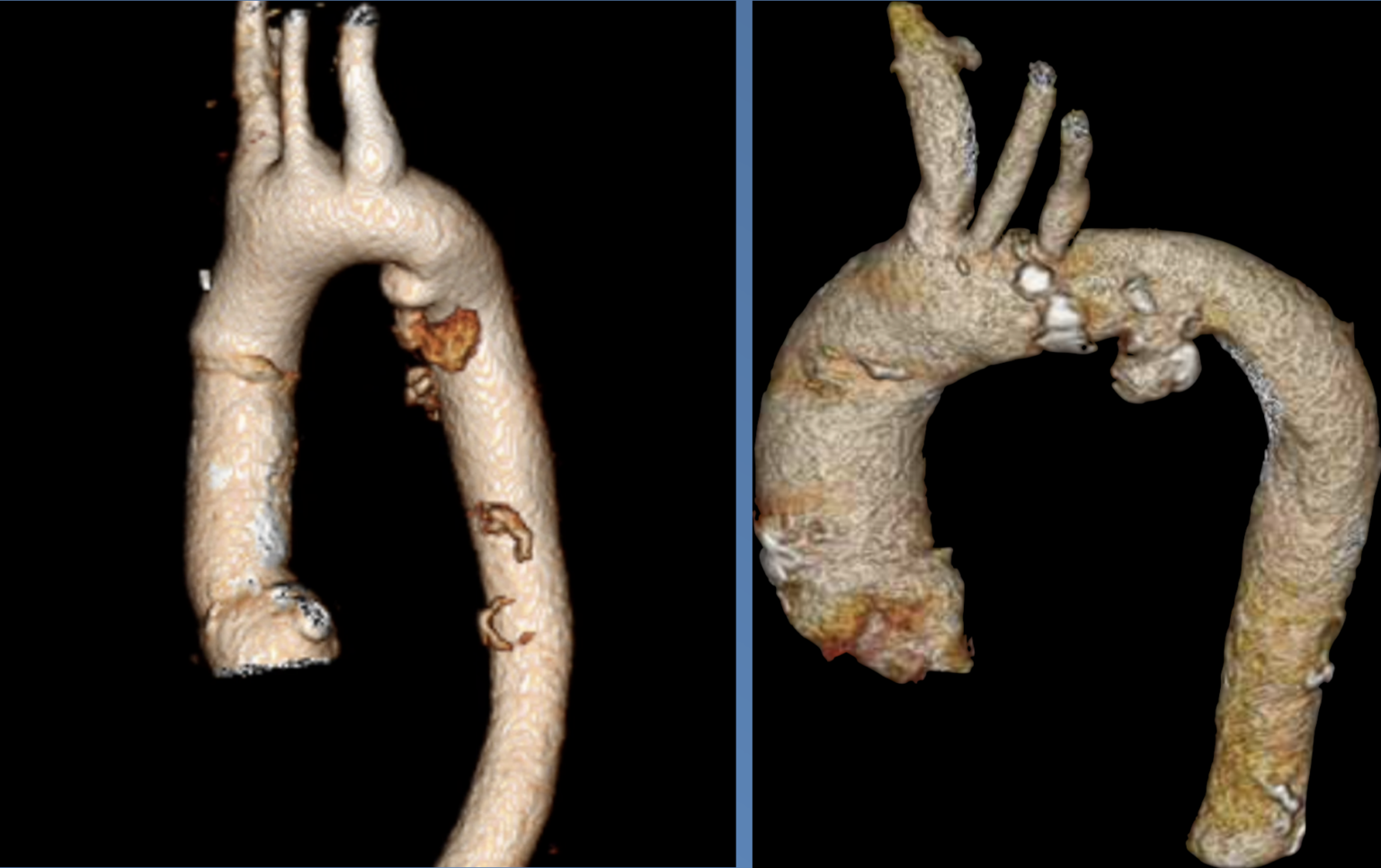 International consensus document on acute type B intramural haematoma ...