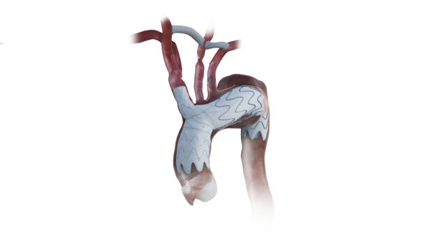 Endospan receives US FDA approval for Nexus aortic arch stent graft ...